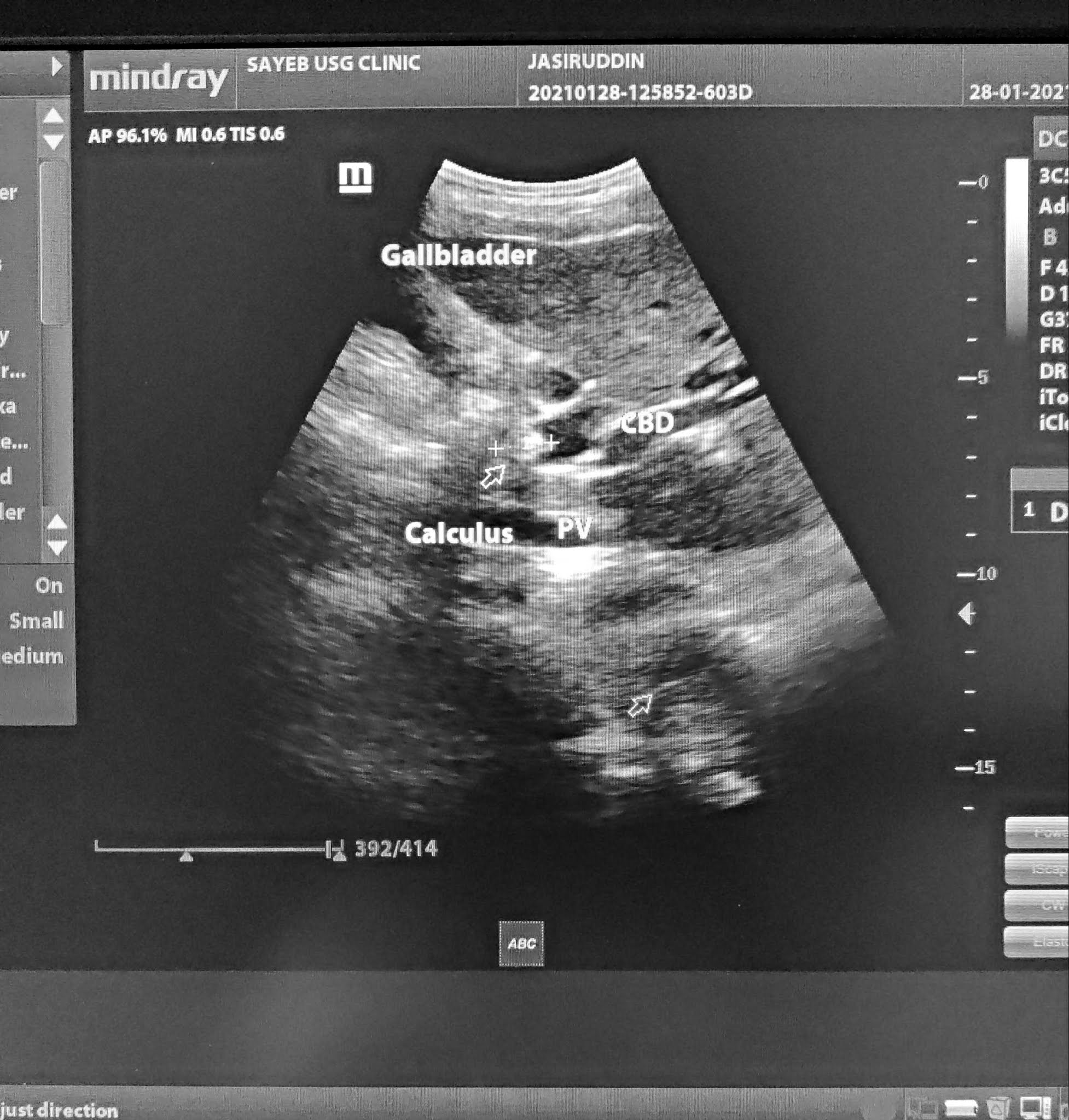 Choledocholithiasis - Causes, Clinical Features, Complication and ...