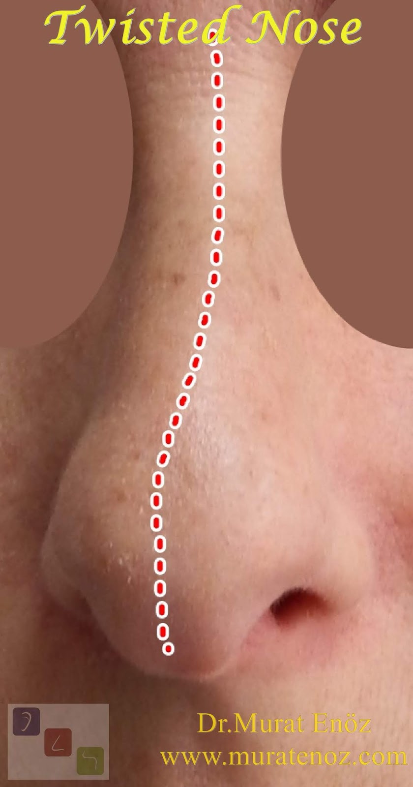 Aesthetic Reconstruction of Twisted Nose, Crooked Nose, Deviated Nose