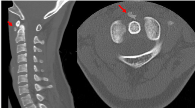Acute Calcific Prevertebral Tendinitis Nonvisible in Plain Radiograph ...