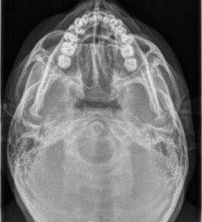 ARCO CIGOMATICO2: ARCO CIGOMATICO