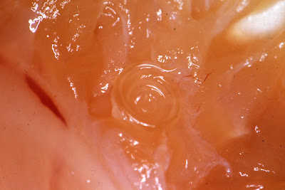 Verminoses: Anisakíase (RARA NO BRASIL)