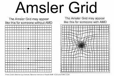 Macular Degeneration