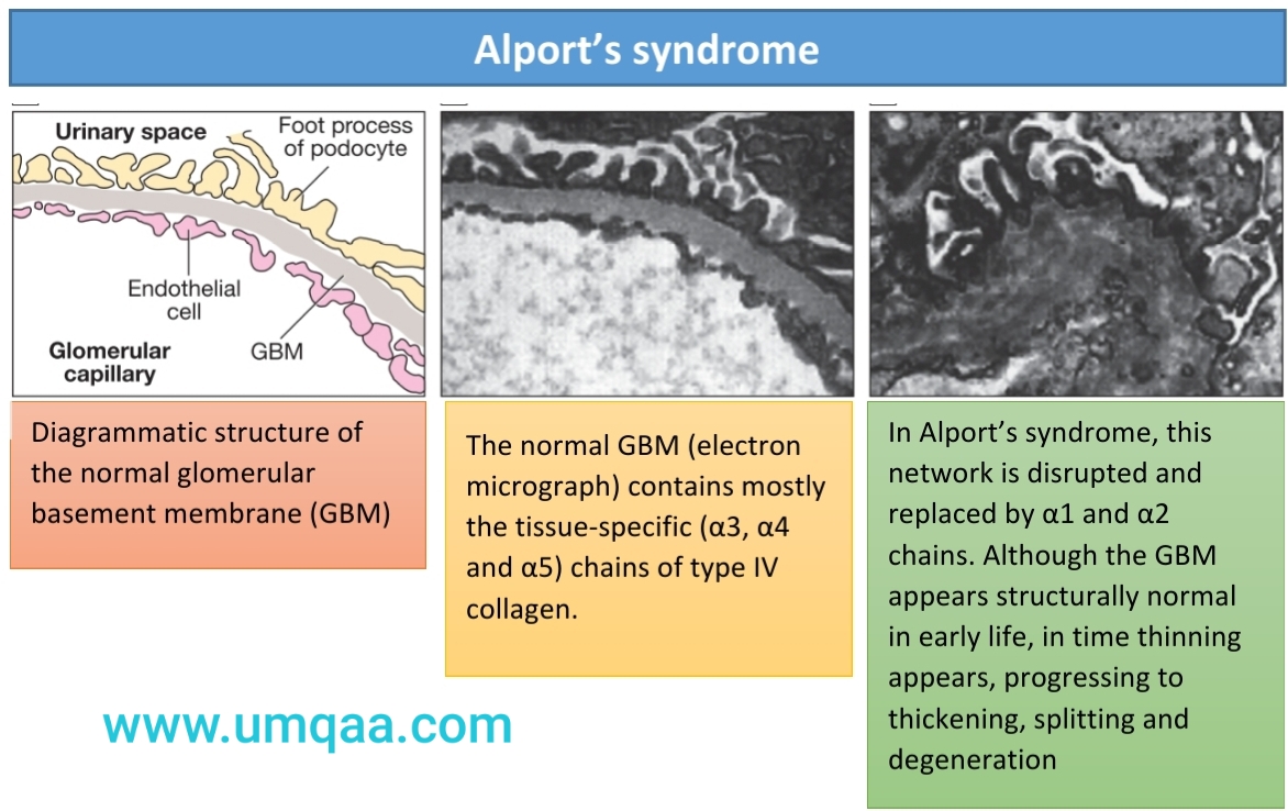 What is Alport’s syndrome?