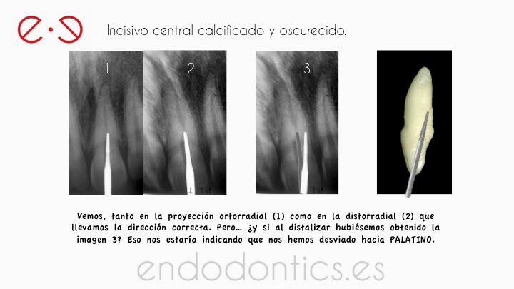 Endodoncia Microscópica en Zaragoza: Incisivo central oscurecido y ...