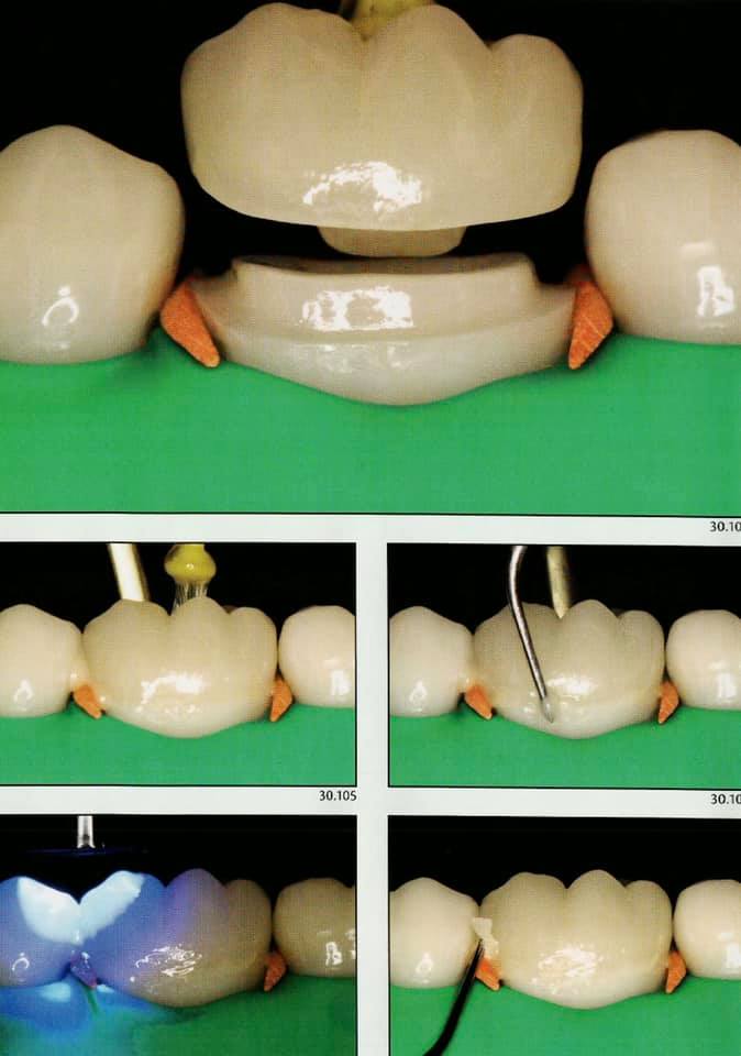 Endocrown .. part 2 | Dental Esthetics