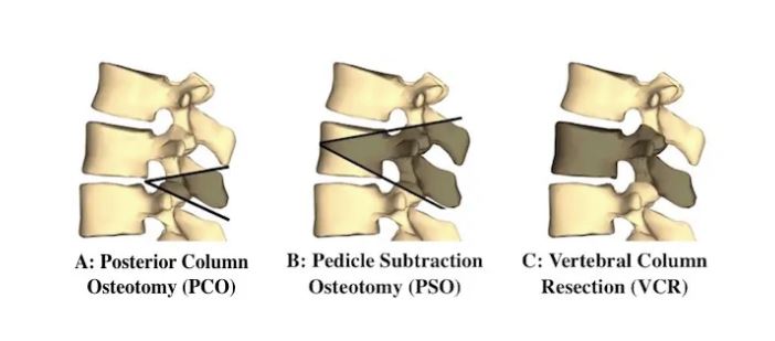 Vertebral Column Resection (VCR) in Pediatric Spinal Deformity ...