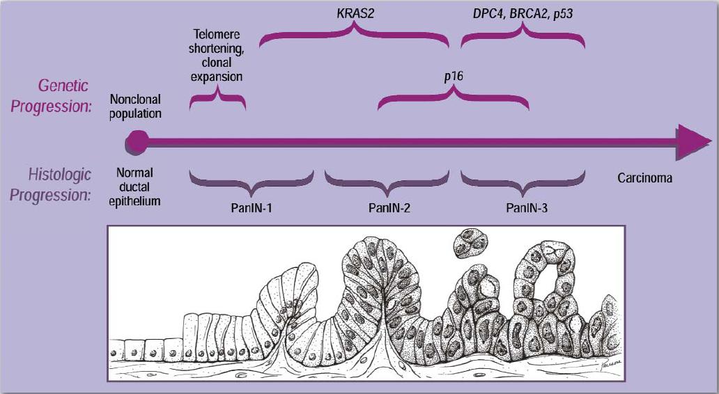 Liga de Patologia - UFC: Tumor de Pâncreas