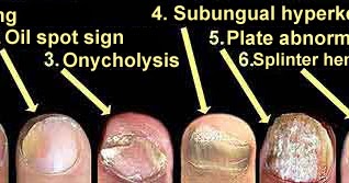 Nail pitting: Nail pitting