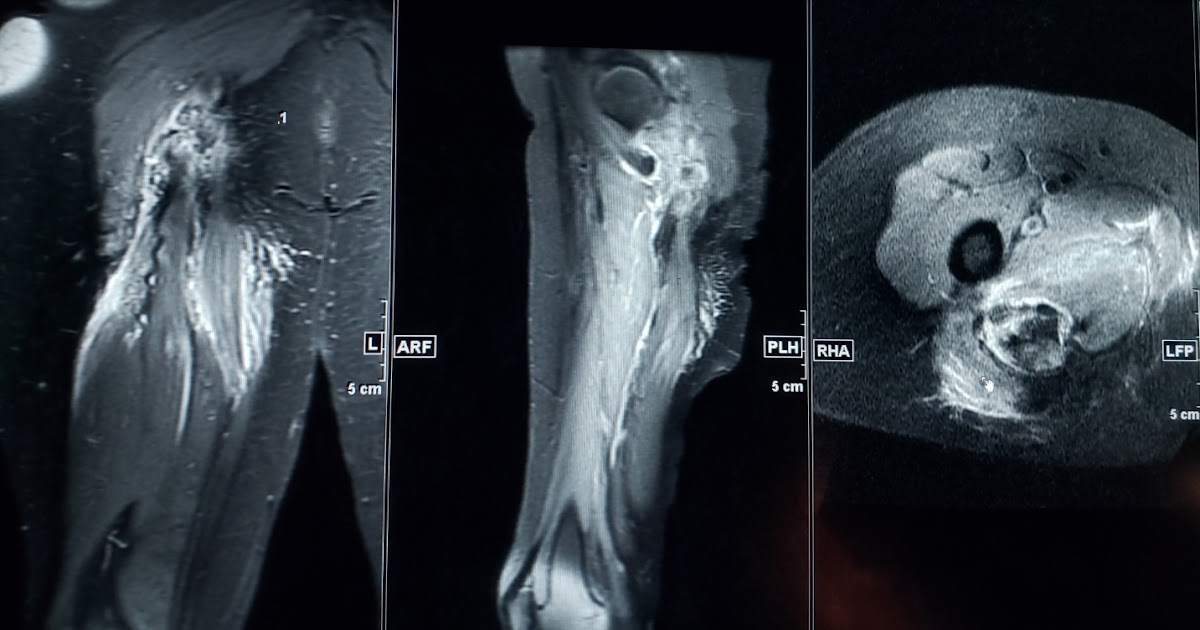 University of Toledo Radiology: Common Hamstring Tendon Rupture