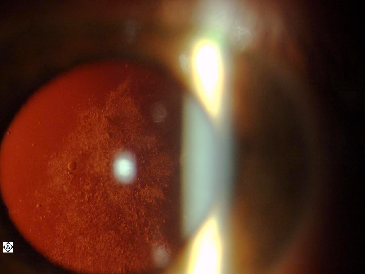Sonoran Desert Eye Center: POSTERIOR SUBCAPSULAR CATARACT