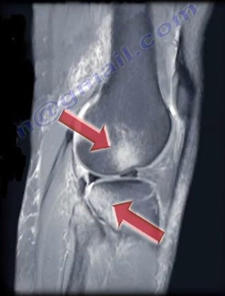 Dr. Nabil Ebraheim's Blogspot: Pivot Shift of the Knee—ACL tear