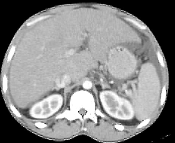 Constrictive Pericarditis-CT - Sumer's Radiology Blog
