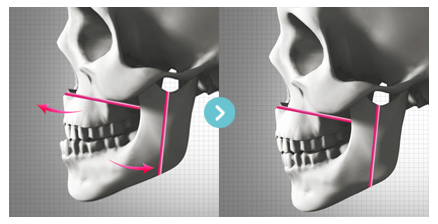 Operasi Dua Rahang, Penting untuk Memperbaiki Sisi Fungsionalnya