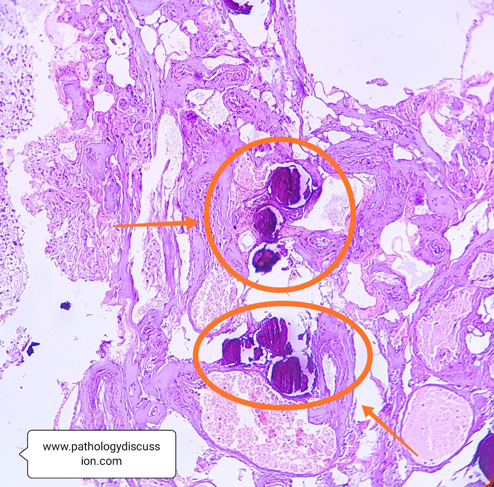 FAQ on Pathologic calcification-Dystrophic calcification-metastatic ...