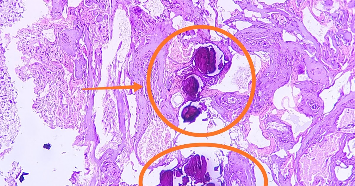FAQ on Pathologic calcification-Dystrophic calcification-metastatic ...