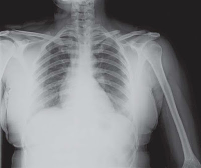 Study Medical Photos: X ray Chest Showing Fracture Of The Left Clavicle.