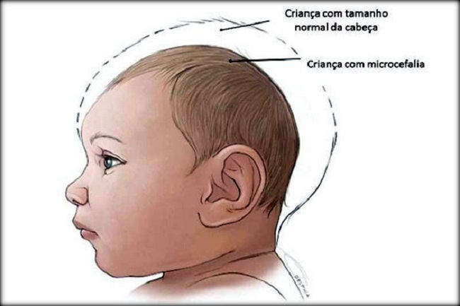 Pesquisadores encontram vírus Zika do Paraná analisando cérebro de ...