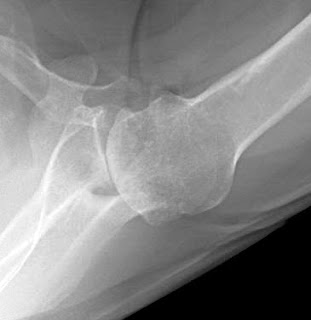 Shoulder Arthritis / Joint Replacement : Ream and run for the B2 ...
