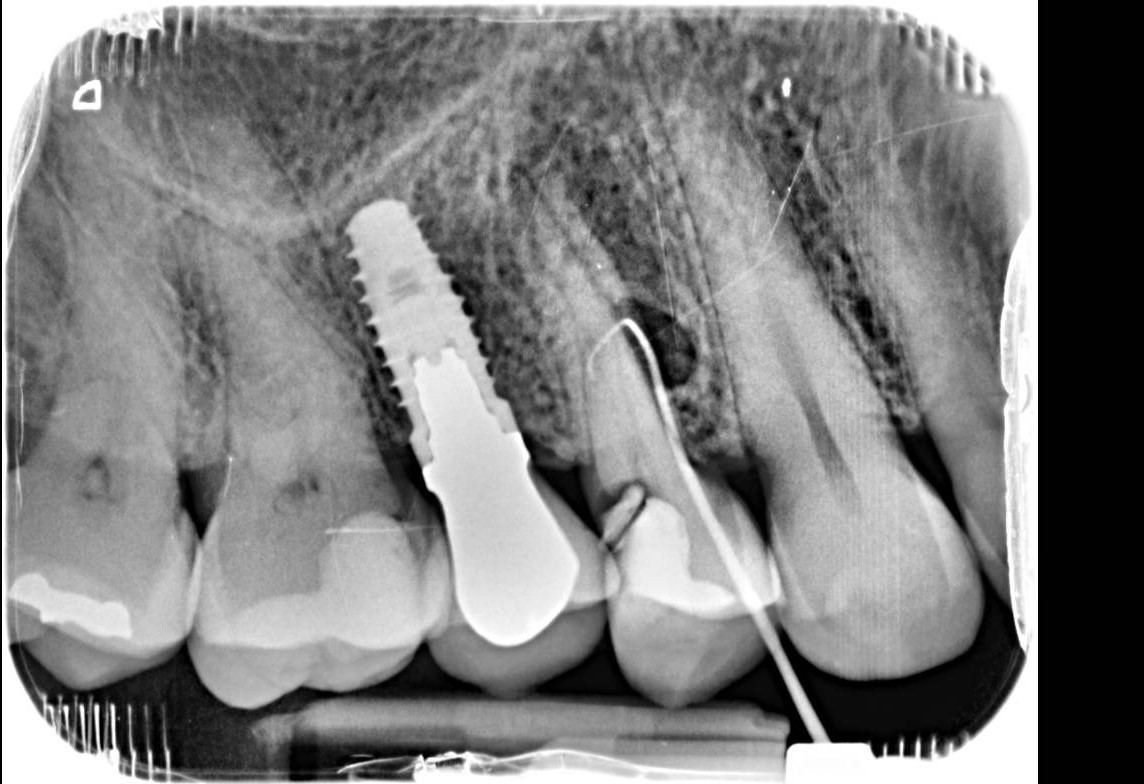 Caso clínico Máster: necropulpectomía en 14