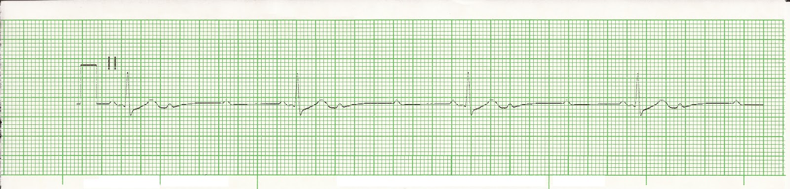 EKG Rhythm Strips 13- Heart Blocks