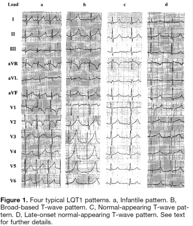 Pedi cardiology: LQTS - Type Recognition by T wave Morphology