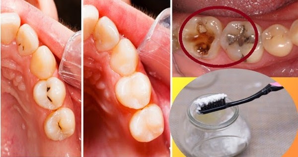 4 Steps To Reduce Tooth Decay Naturally