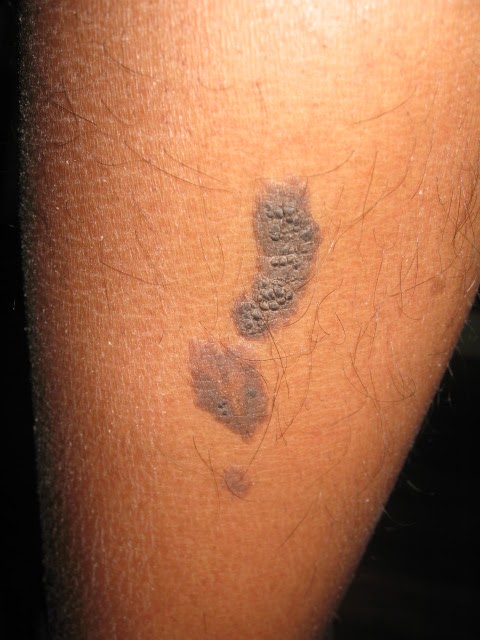 The Armchair Dermatologist: Linear Epidermal Nevus