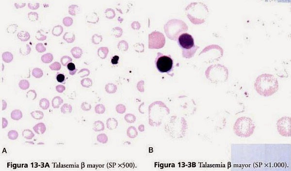 Células importantes en hematología: TALASEMIA BETA MAYOR