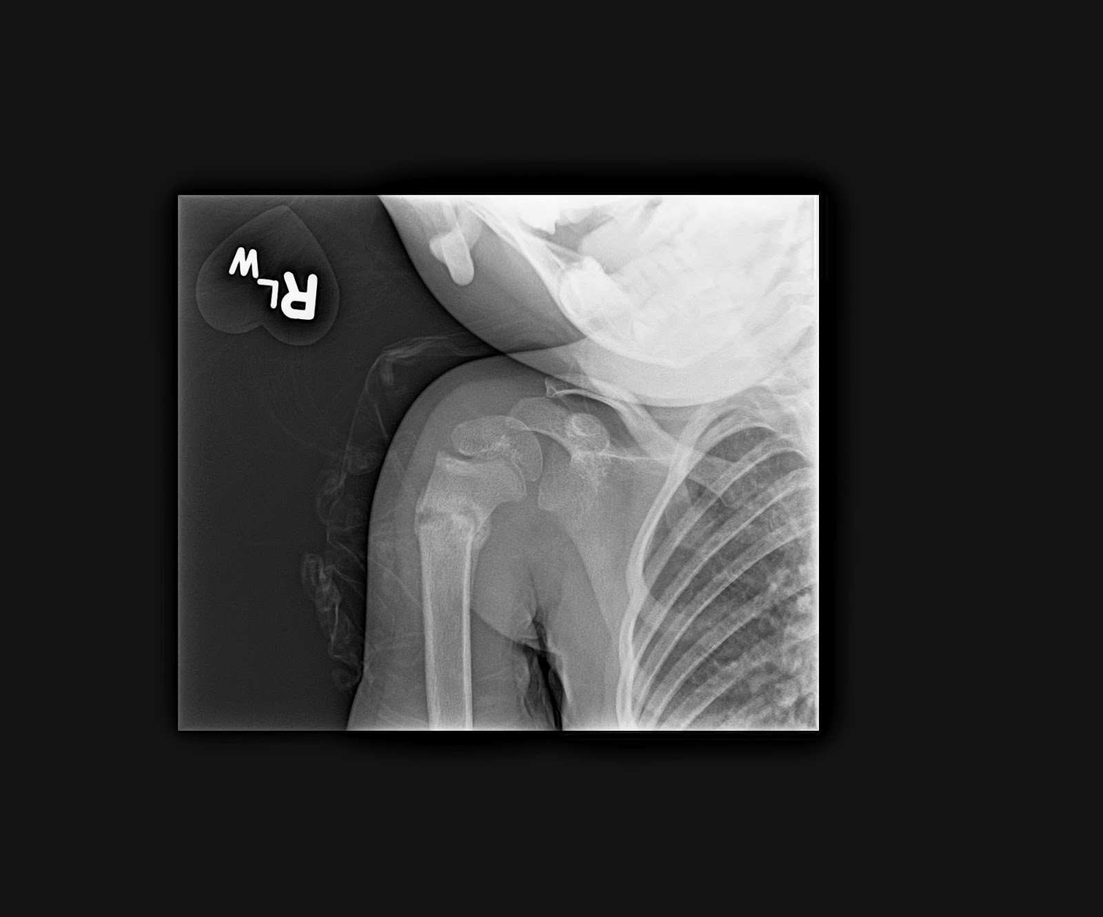 Shoulder and Elbow Surgery: The remodelling potential of the proximal ...