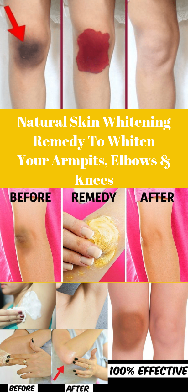 Natural Skin Whitening Remedy To Whiten Your Armpits, Elbows & Knees ...