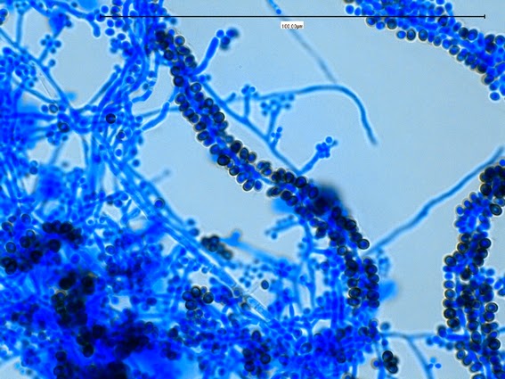 Fun With Microbiology (What's Buggin' You?): Sporothrix schenckii ...