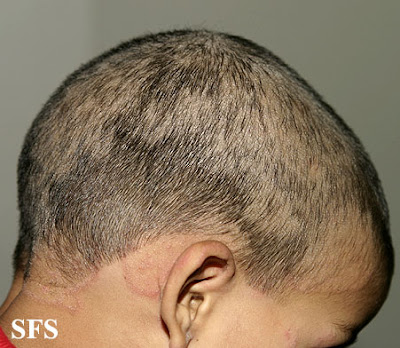 Doctors Gates: Between Tinea capitis and Psoriasis of the scalp