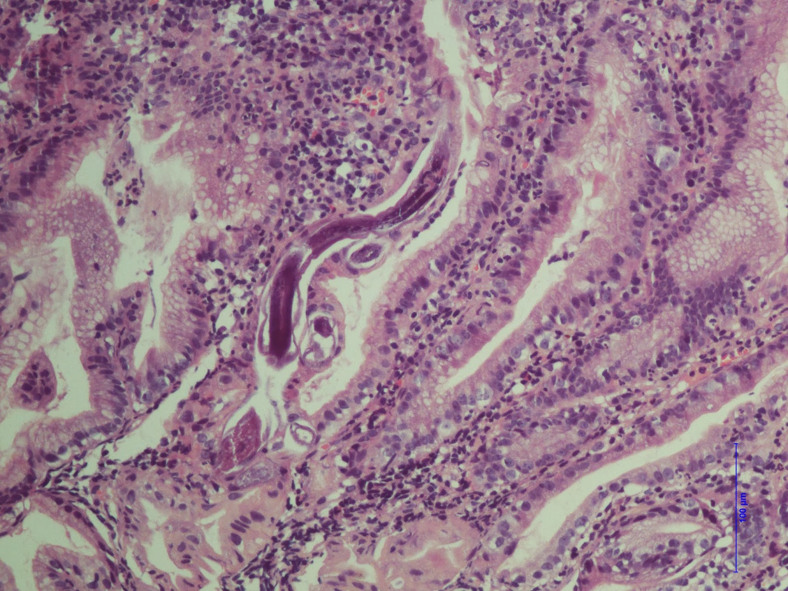 Entendiendo la patologia: Strongyloides en Duodeno