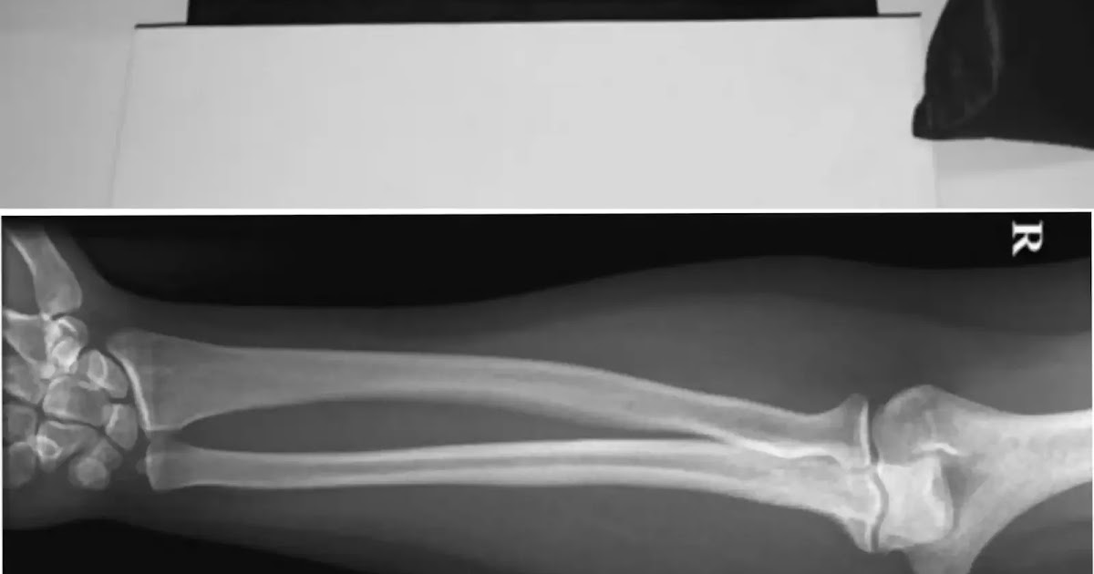 broken forearm x-ray - paramedical guru