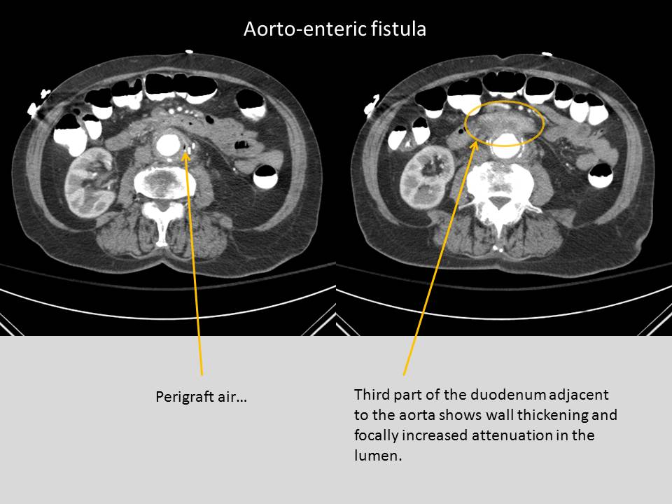 The Pump and the Tubes: Aorto-enteric fistula