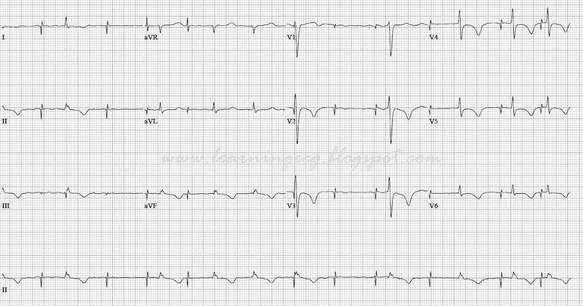 ECG Rhythms: AF with failure to capture and intermittent undersening