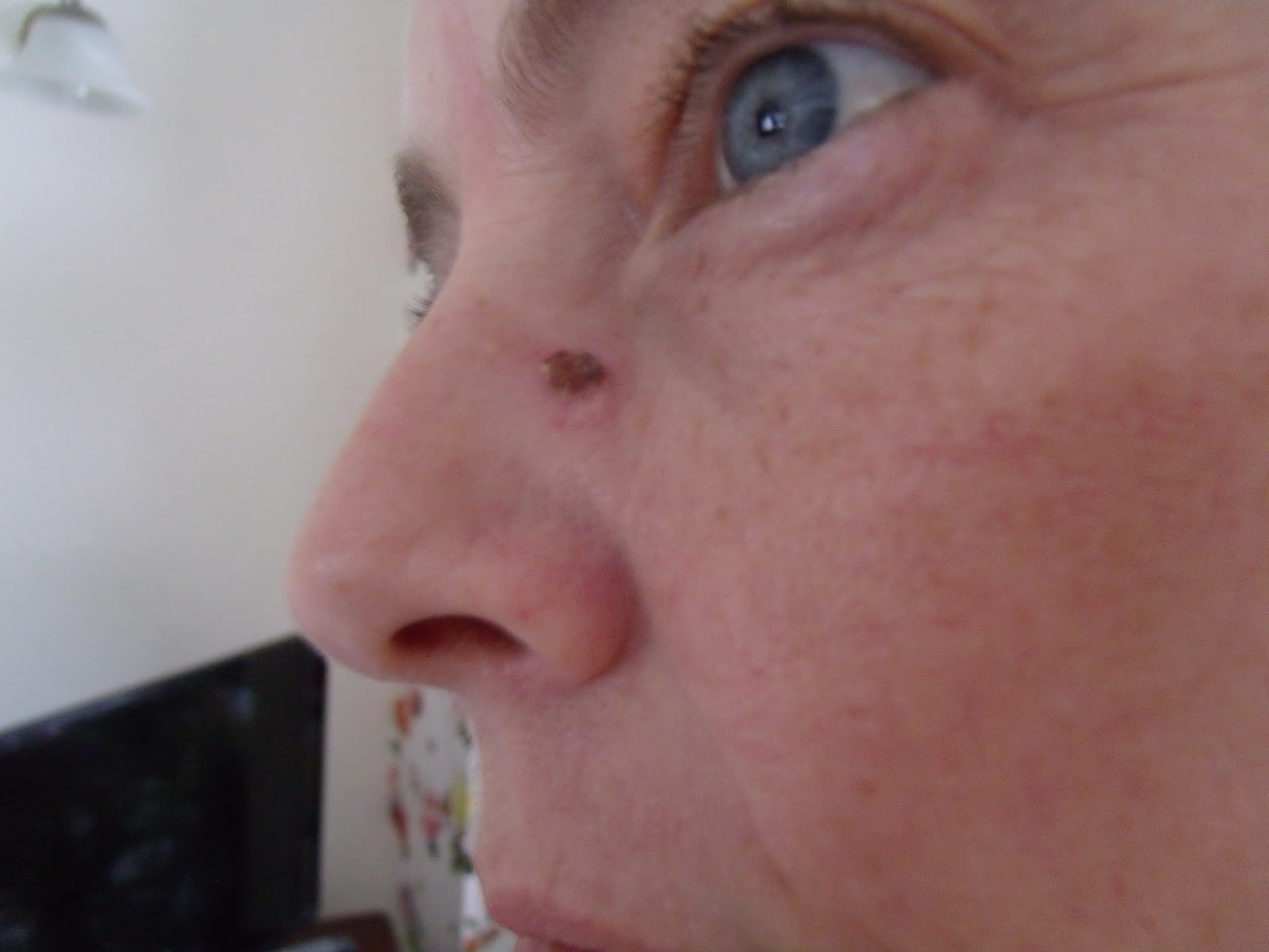 Nose update..the plaster is off.