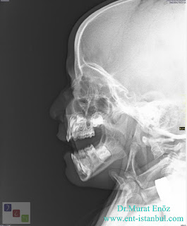 Nasal Fractures - Causes, Symptoms, Diagnosis, Treatment