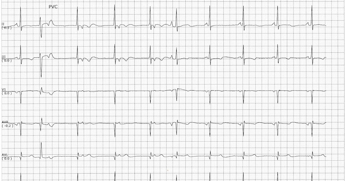 A competing junctional rhythm