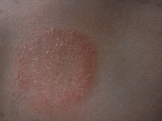 What's the what?: Ringworm