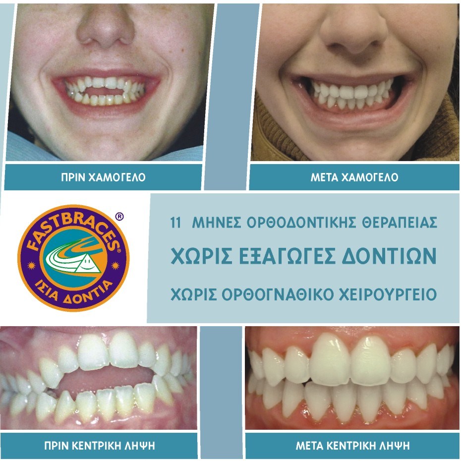 The Sekouratoi: ΟΡΘΟΔΟΝΤΙΚΗ (ΙΣΙΑ ΔΟΝΤΙΑ) ΣΕ ΛΙΓΟΤΕΡΟ ΧΡΟΝΟ ΚΑΙ ΧΩΡΙΣ ...