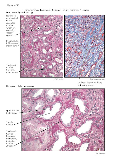 CHRONIC TUBULOINTERSTITIAL NEPHRITIS - pediagenosis