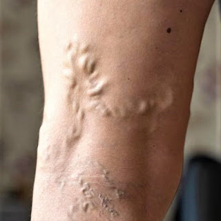 Wat zijn spataderen (spataders)