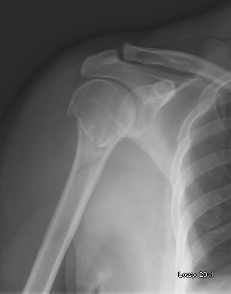 Shoulder and Elbow Surgery: Corrective osteotomy for surgical neck ...