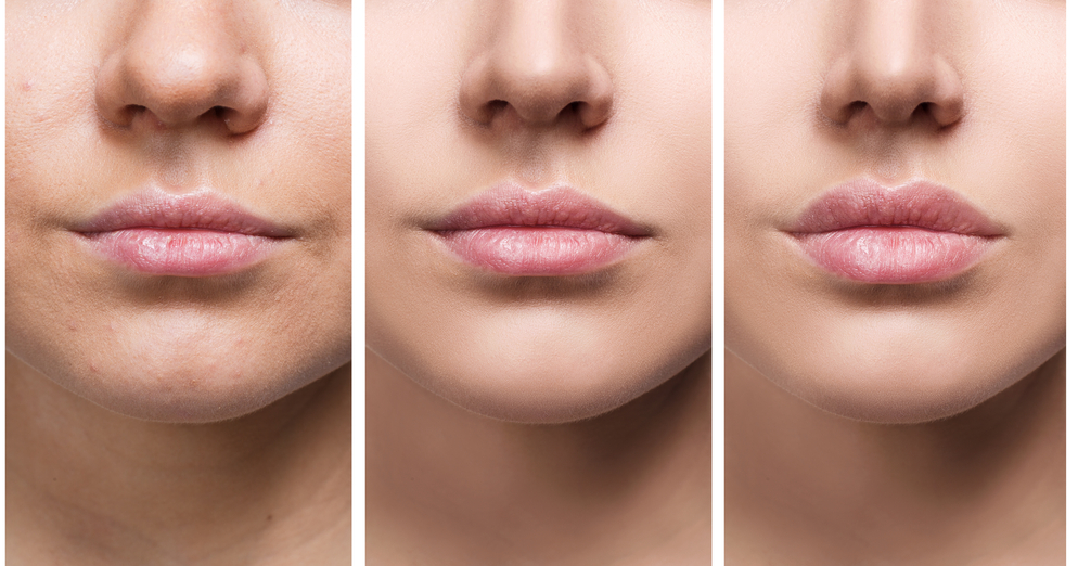 Metody powiększania ust