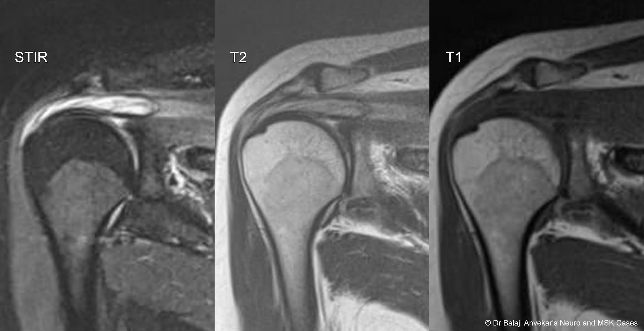 Synovial Cyst Shoulder