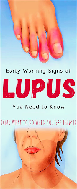 13 Early Warning Signs of Lupus You Need to Know (and what to do the ...