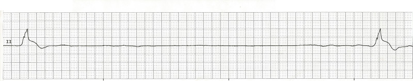 EKG Rhythm Strips 91 Various Agonal Rhythms