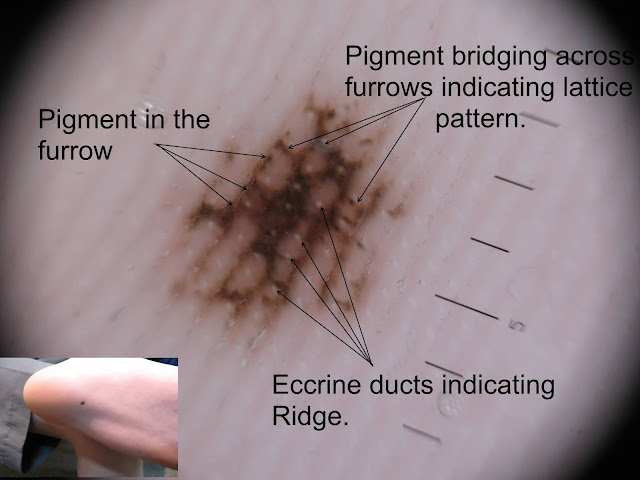 Dermoscopy Features as Clues: Lines Parallel