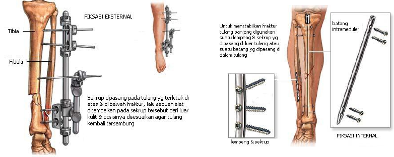 KAMUS KESEHATAN: BUDAYA BESAKA SUKU TIMOR : Pengobatan Tradisional ...